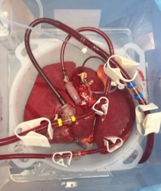 Normothermic Machine Perfusion in Liver Transplants Safe, Effective | Duke Health Referring ...